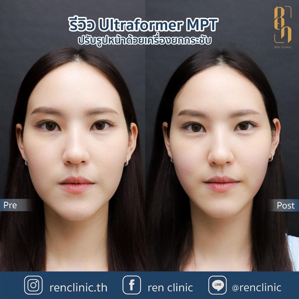 Ultraformer MPT ราคาเท่าไหร่ อัปเดตโปรโมชั่น 2025 มีรีวิว!