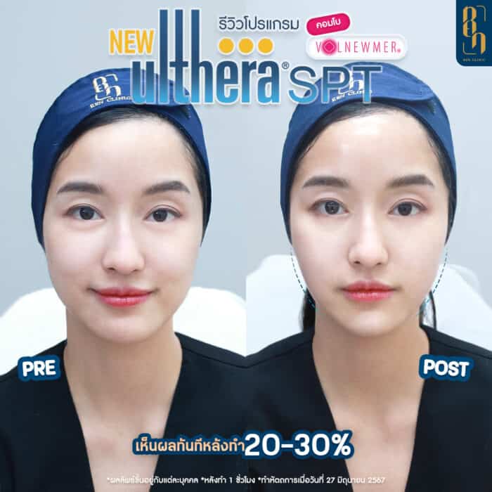Ultraformer VS. Ulthera เลือกแบบไหนดี ต่างกันอย่างไรบ้าง